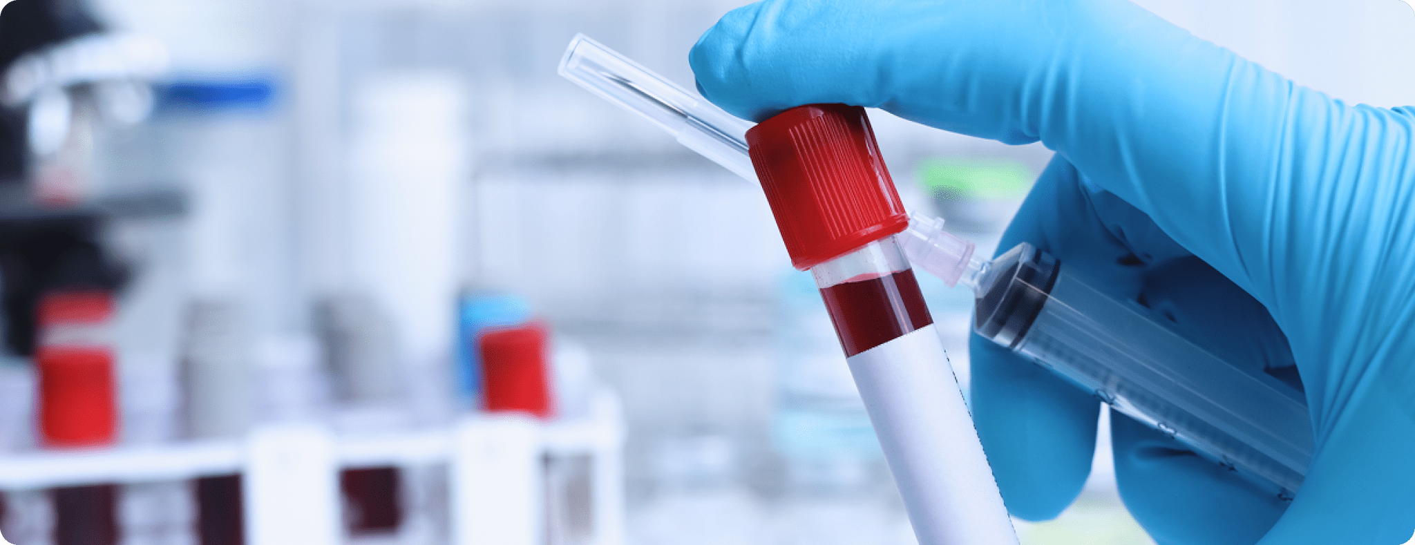 Typhoid Tests Explained: Widal, TyphiDot & Blood Culture